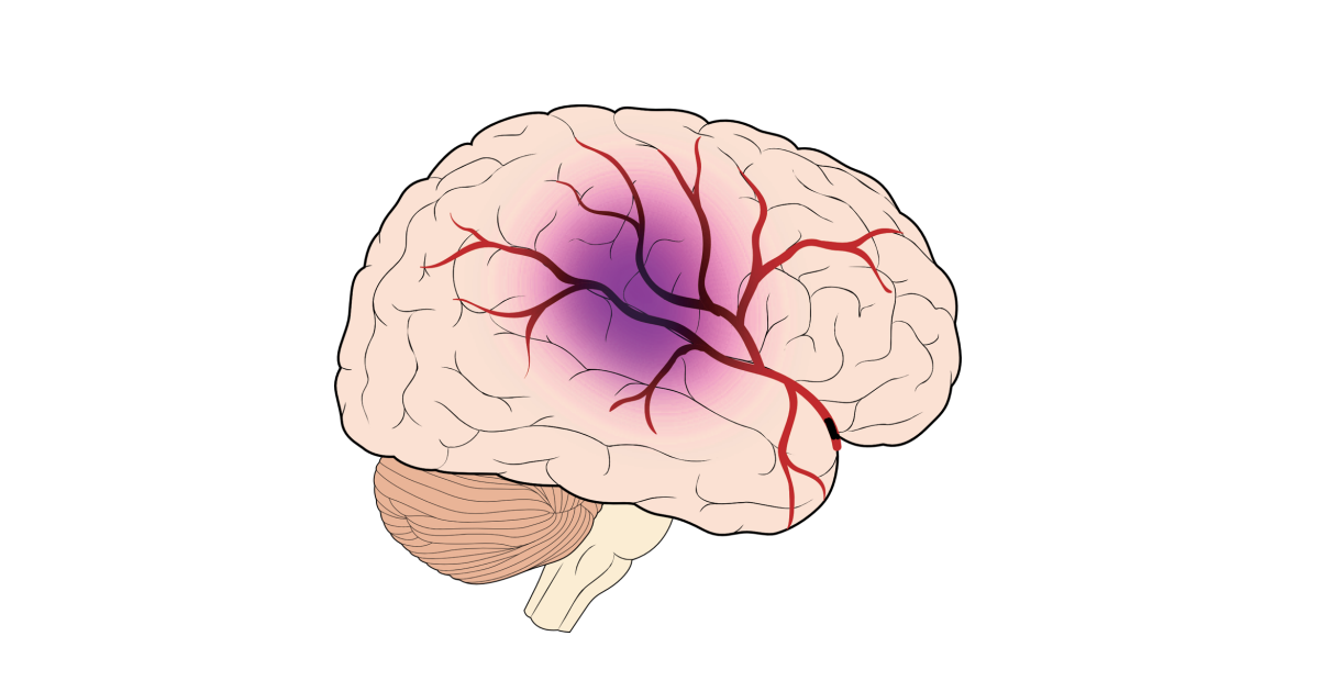 Stroke Prediction Using Machine Learning Stroke Prediction Using Machine Learning